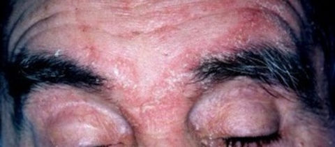 Eczemas | Tipos de eczema y tratamiento - Dr. Daudén Dermatología